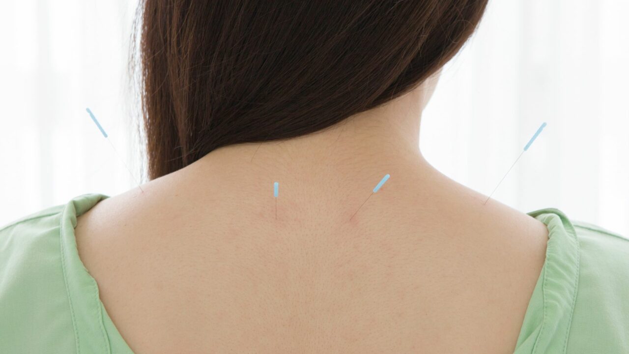 Treating Frozen Shoulder with Traditional Chinese Medicine